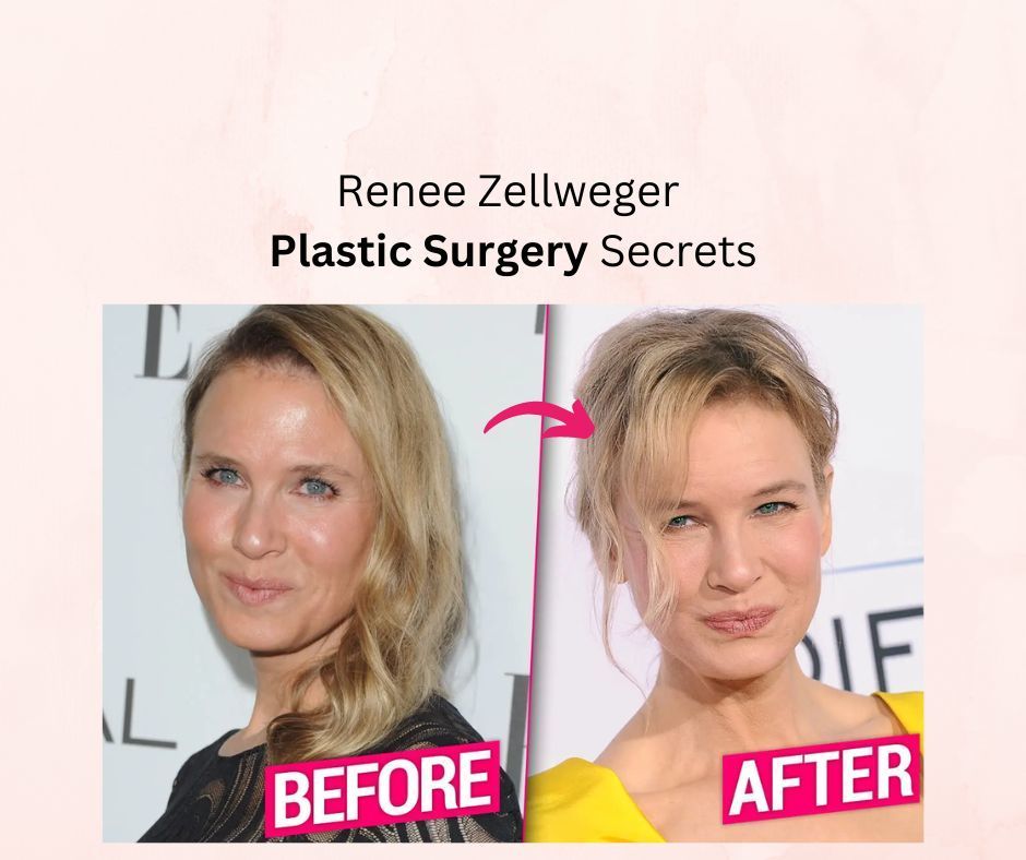 Renee Zellweger Plastic Surgery Secrets - Complete Guide | Fabbon