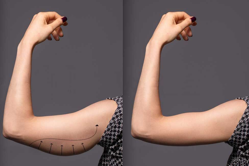 Brachioplasty Complete Guide 2022 - Pros, Cons, Side Effects | Fabbon