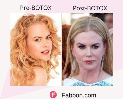 25 Celebrities Who Use Botox - 2022 (With Images) | Fabbon