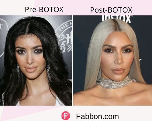 25 Celebrities Who Use Botox - 2022 (With Images) | Fabbon