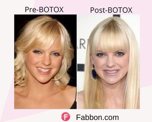 25 Celebrities Who Use Botox - 2022 (With Images) | Fabbon