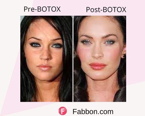 25 Celebrities Who Use Botox - 2022 (With Images) | Fabbon