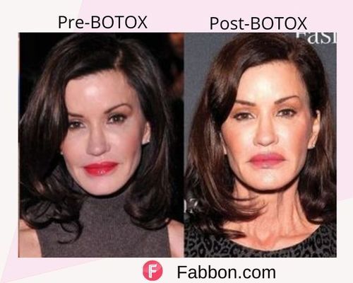 25 Celebrities Who Use Botox - 2022 (With Images) | Fabbon