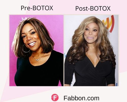 25 Celebrities Who Use Botox - 2022 (With Images) | Fabbon