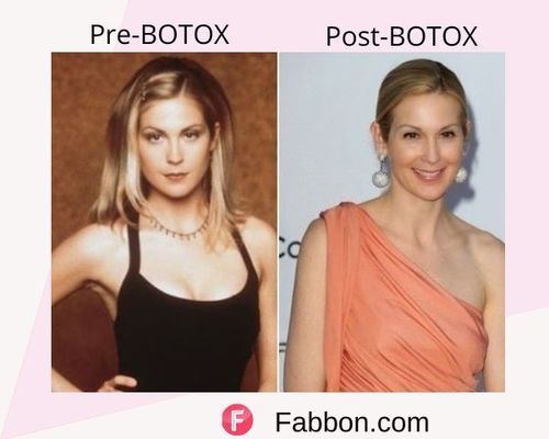 25 Celebrities Who Use Botox - 2022 (With Images) | Fabbon