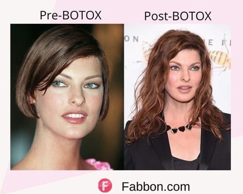 25 Celebrities Who Use Botox - 2022 (With Images) | Fabbon