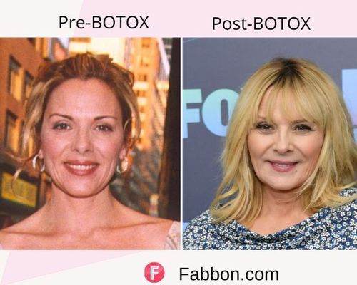 25 Celebrities Who Use Botox - 2022 (With Images) | Fabbon