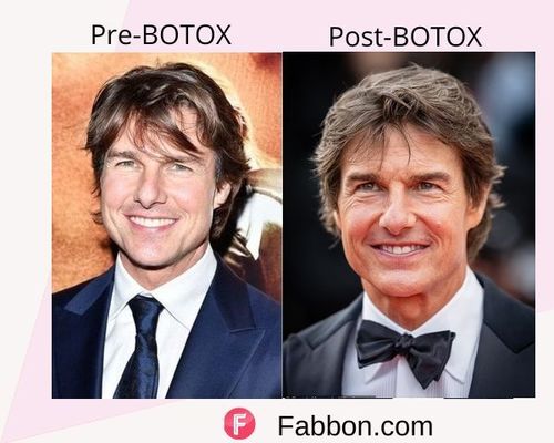 25 Celebrities Who Use Botox - 2022 (With Images) | Fabbon