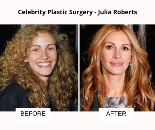 Celebrity Plastic Surgery: 31 Before And After Images | Fabbon