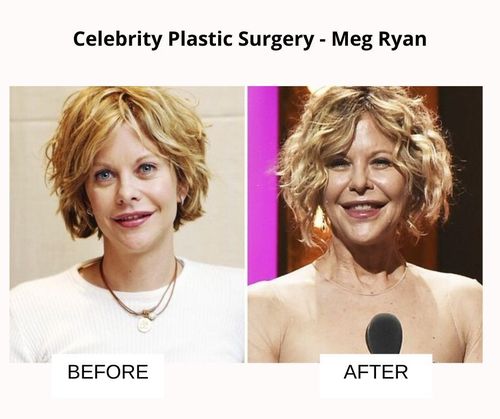 Celebrity Plastic Surgery: 31 Before And After Images | Fabbon